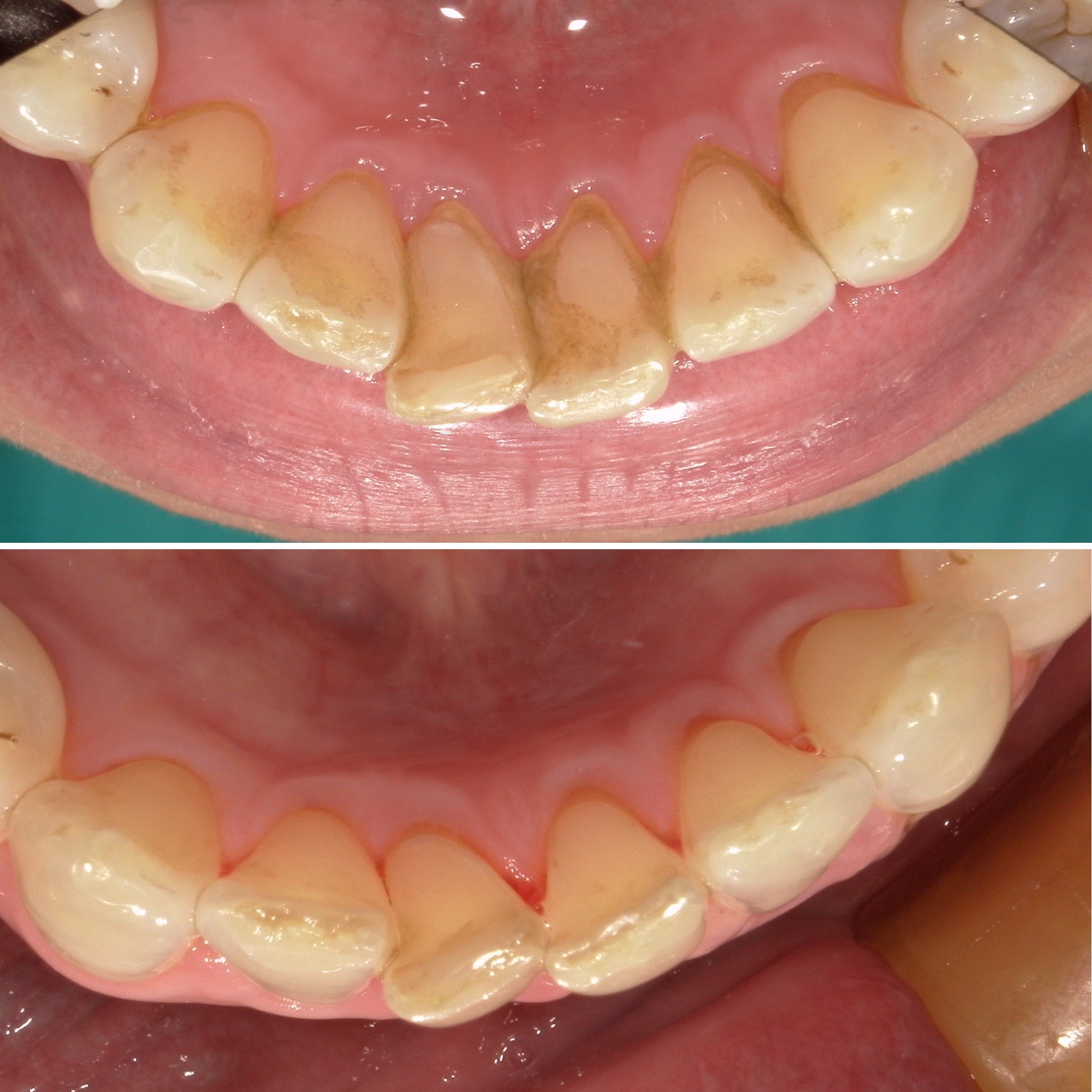 歯石取りなんで何回もかかるの？ | 金沢の歯医者「25歯科・矯正歯科」